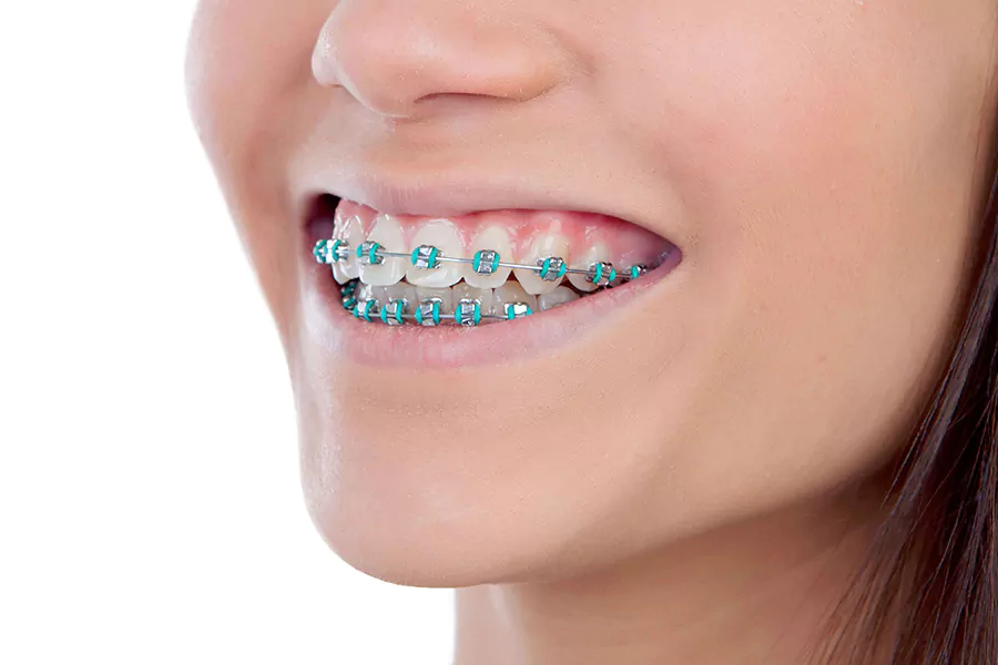 کش ارتودنسی | معرفی 0 تا صد (مزایا و معایب) + زمان تعویض | لبخند درمان